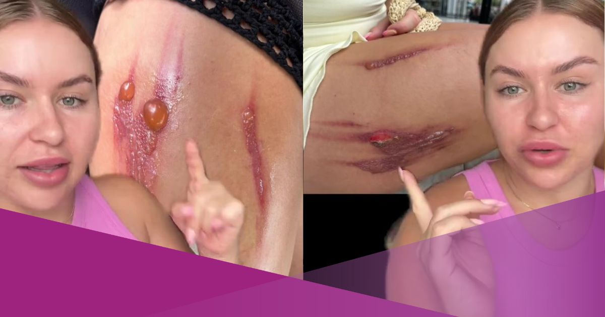 Bali Bug (Tomcat) Bites Cause Severe Blisters in Foreign Tourist